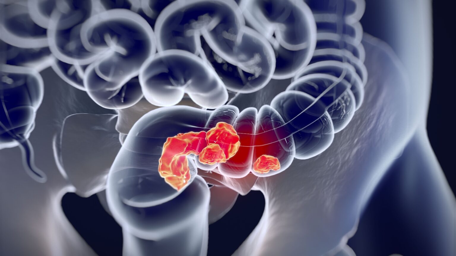 Deadly Diseases That Mimic IBS - FODMAP Everyday
