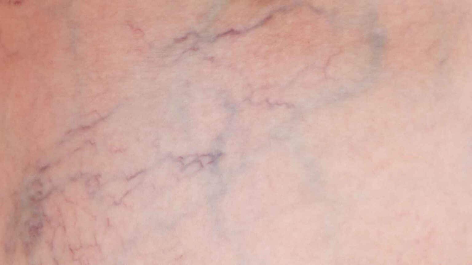 Should you be concerned about bulging veins? - FODMAP Everyday